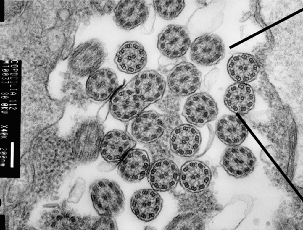 Diagnosing PCD | PCD Foundation